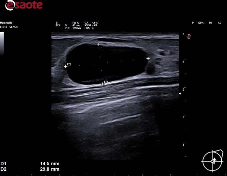 Le cisti mammarie - dott. Francesco Pellegrini - Senologia